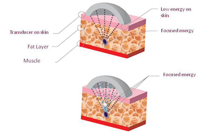 Máquina de perda de peso em menor emagrecimento - Compre UltraShape ...
